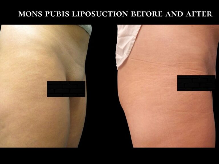 Mons pubis liposuction near me: safe, effective treatment